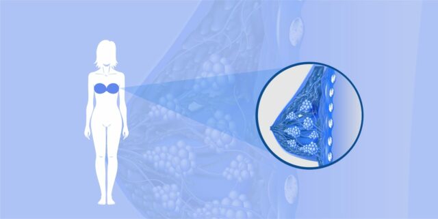 Operacije malignih tumora dojke - SAVA SURGERY