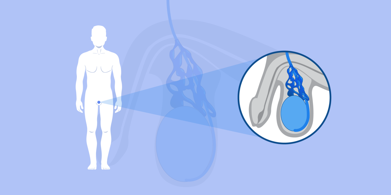 Operacija varikocele – SAVA SURGERY